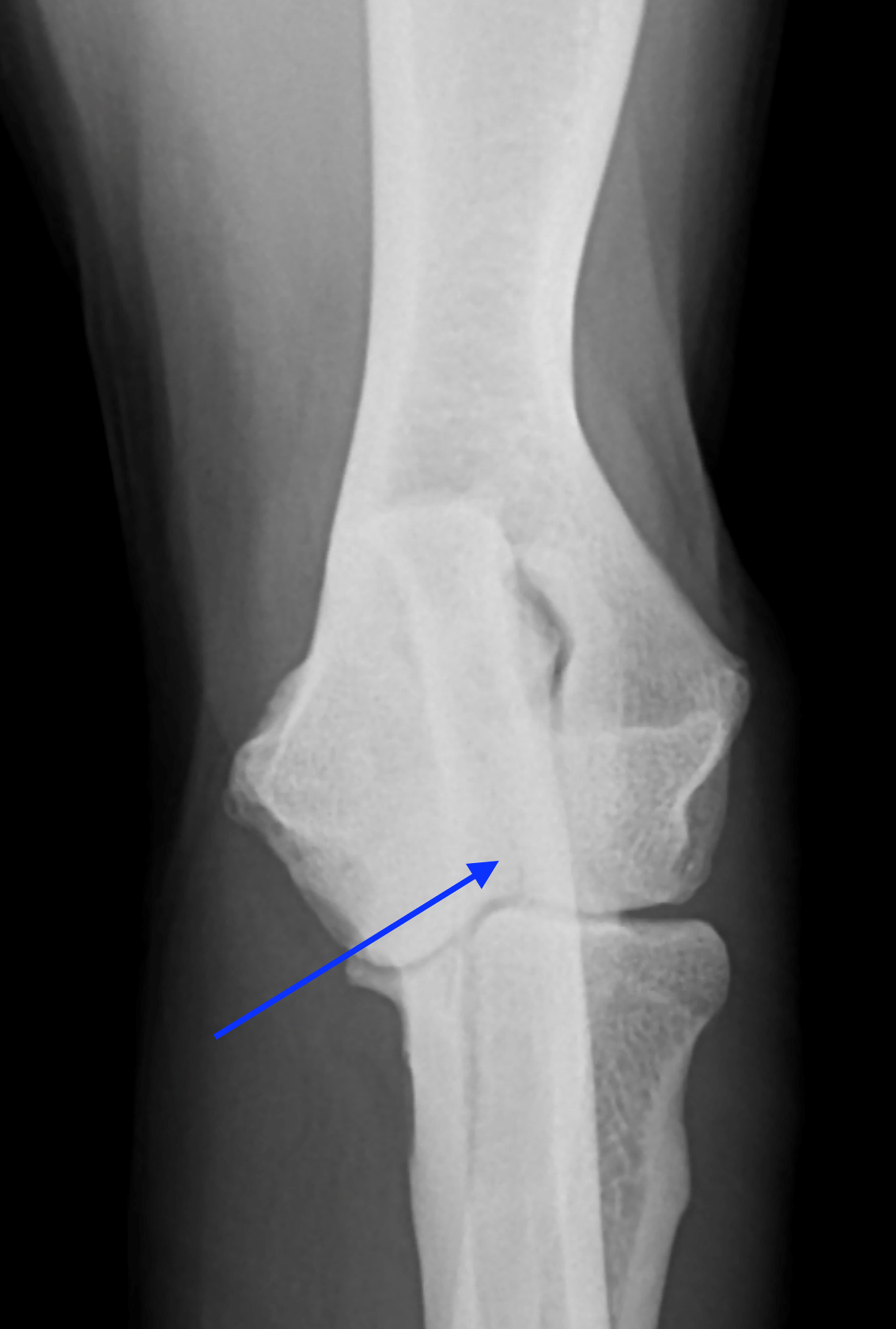 L'ossification incomplète du condyle huméral chez le chien : quand la ...