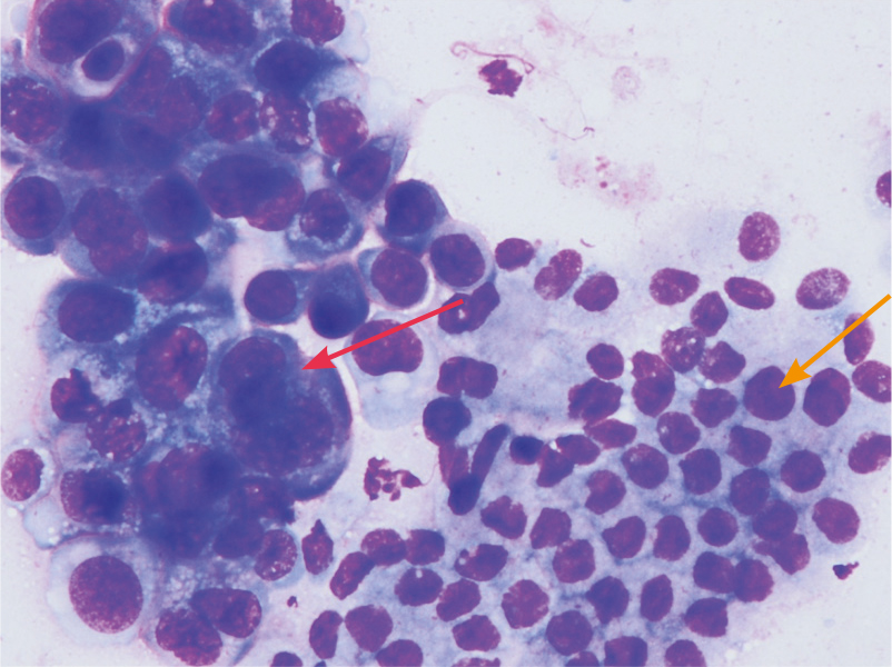 Détection par cytologie urinaire des carcinomes prostatiques et ...