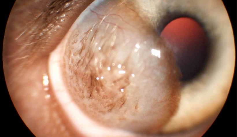 Lésion oculaire temporale droite chez un braque de Weimar : quel est ...